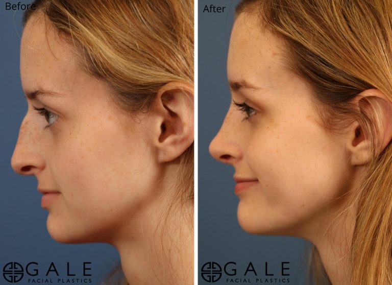 Rhinoplasty in Riverton, UT | Dr. Derrick Gale